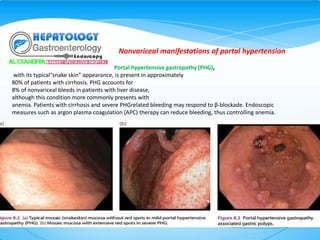 Gastrointestinal dysfunction in liver cirrhosis | PPT