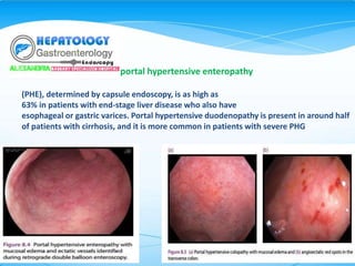 Gastrointestinal dysfunction in liver cirrhosis | PPTX
