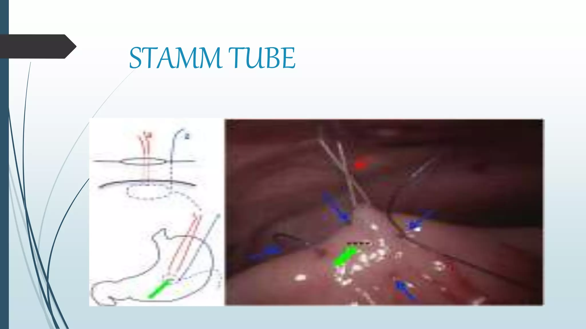 Gastrointestinal intubation.pptx