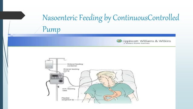 Gastrointestinal intubation.pptx | Digestive Disorders | Diseases and ...