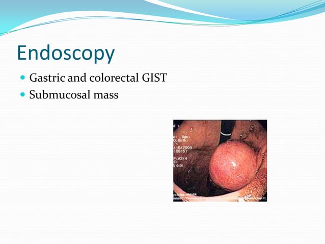 Gastrointestinal stromal tumor(gist) | PPTX