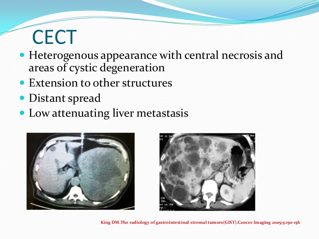 Gastrointestinal Stromal Tumor Gist
