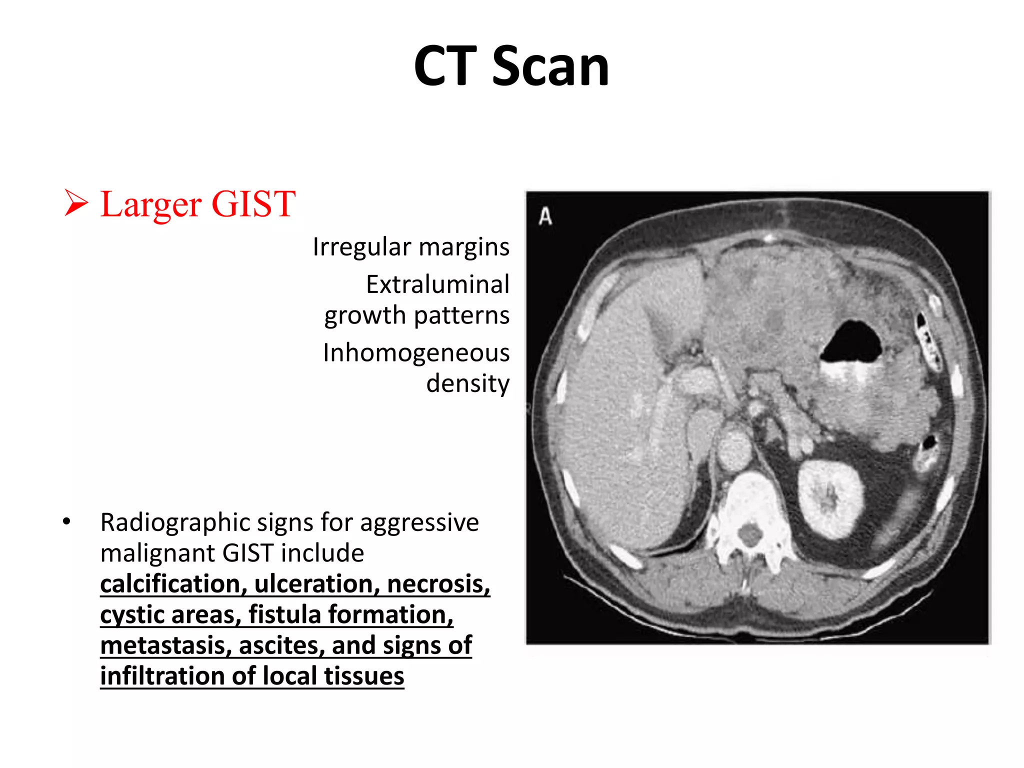 Gastrointestinal stromal tumours | PPTX