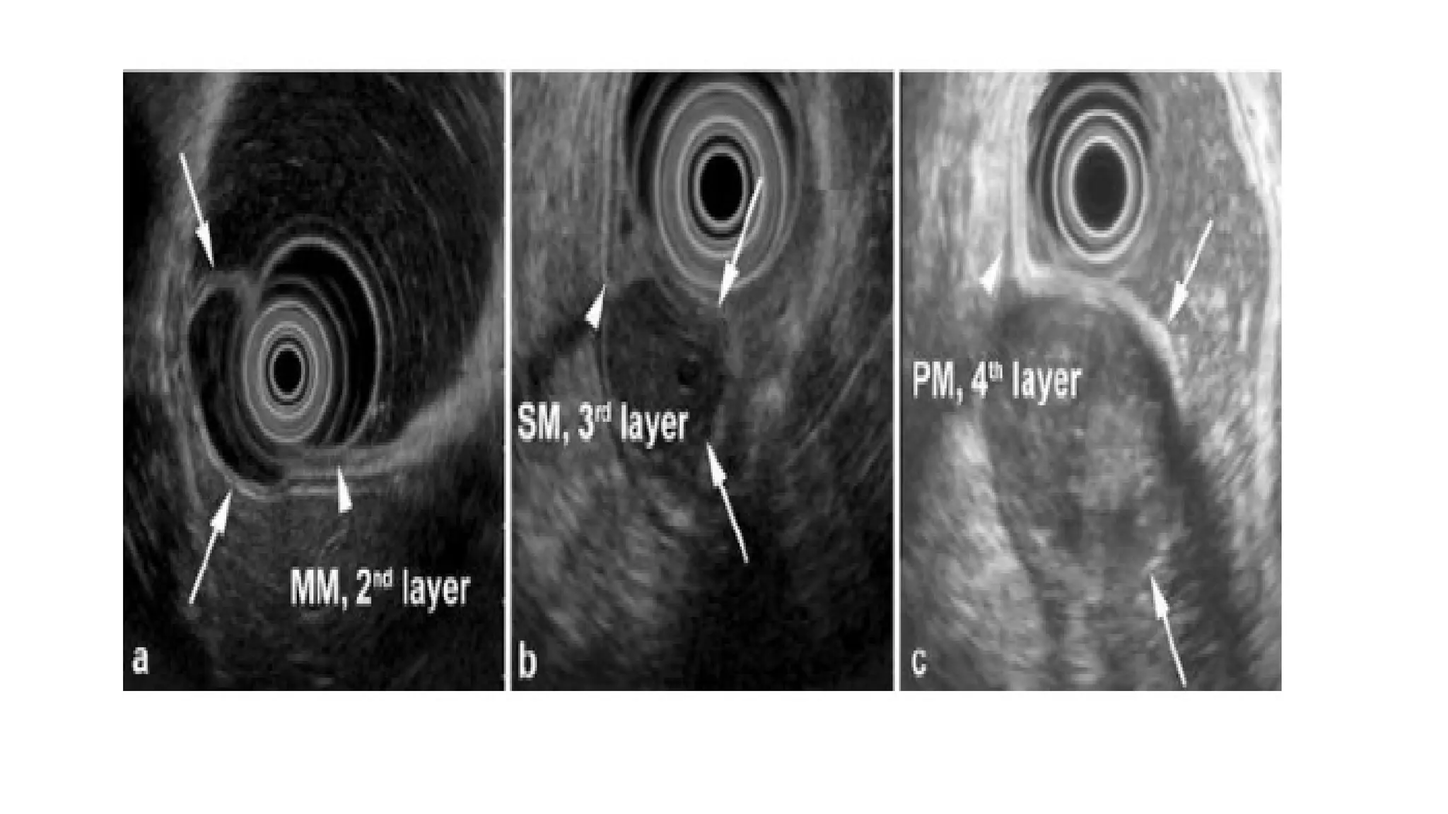Gastrointestinal subepithelial lesions.pptx