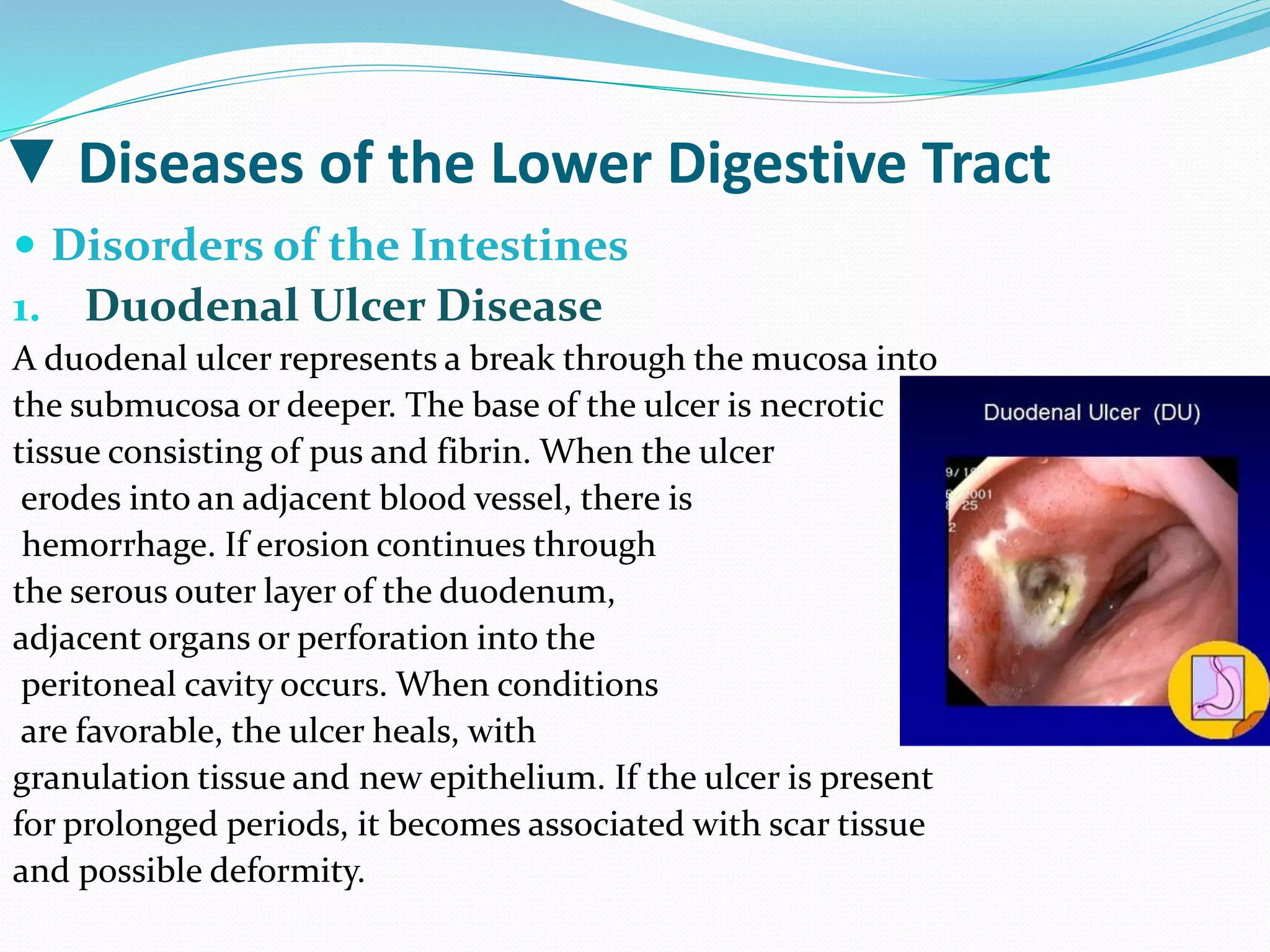 Gastrointestinal Tract Disorder | PPTX