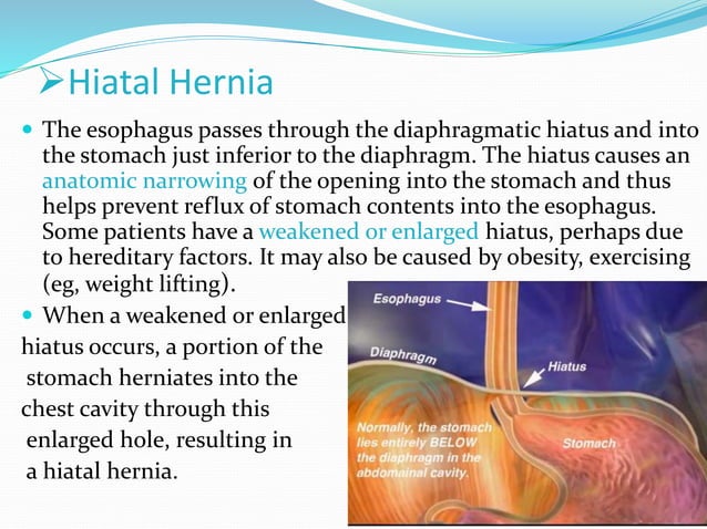 Gastrointestinal Tract Disorder | PPTX