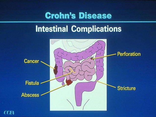 Gastrointestinal Tract Disorder | PPTX