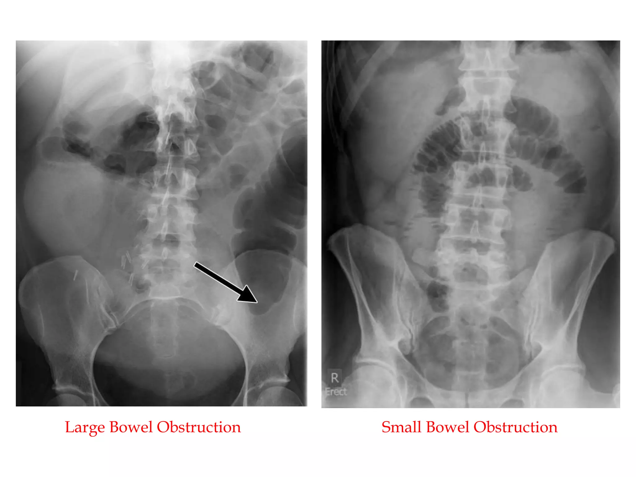 Gastro intestinal tract (abdomen) radiology | PPTX