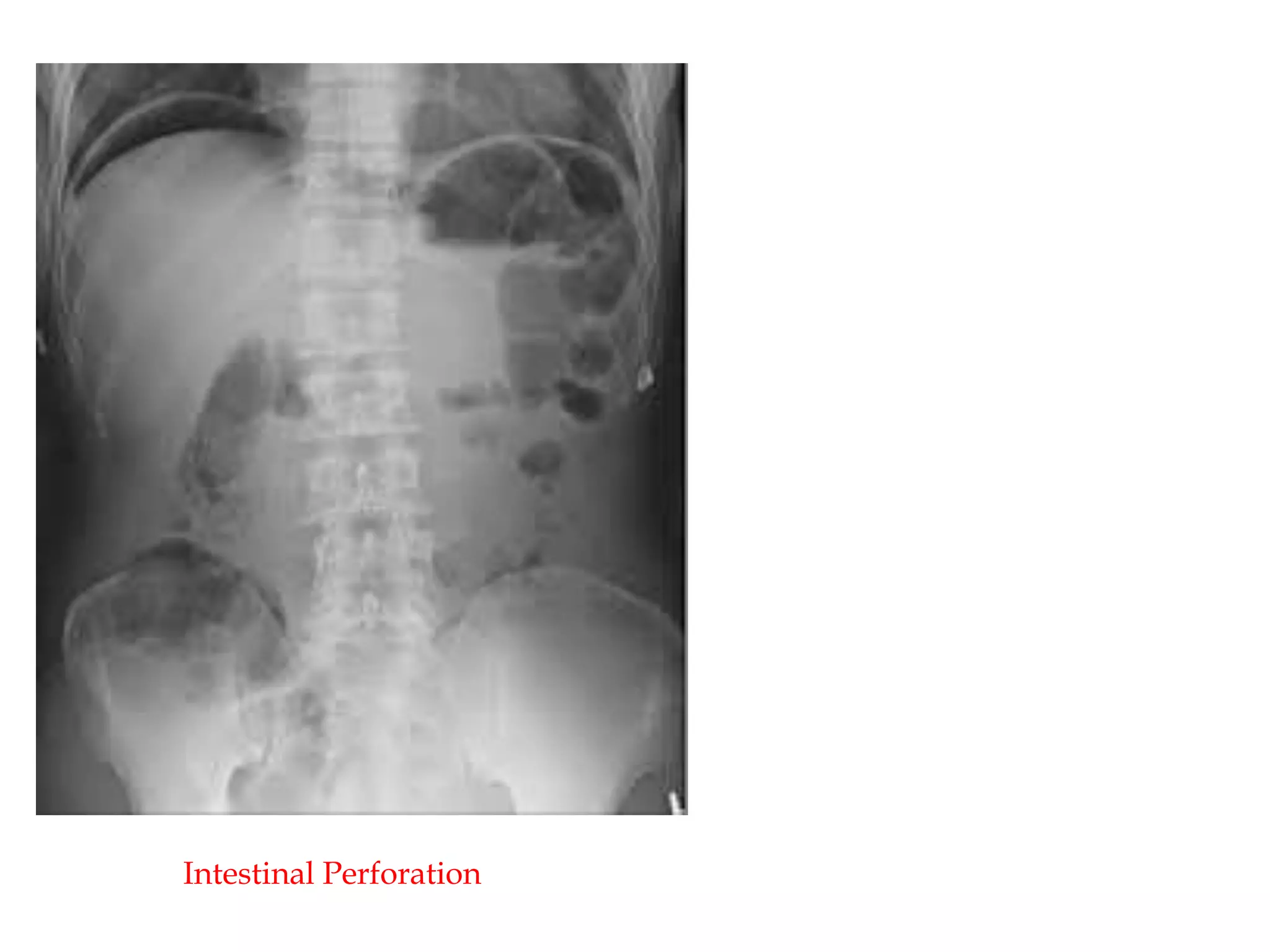 Gastro intestinal tract (abdomen) radiology | PPTX