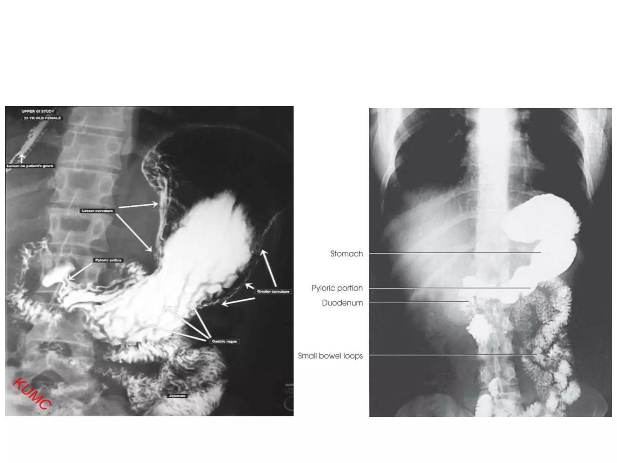 Gastro intestinal tract (abdomen) radiology | PPTX
