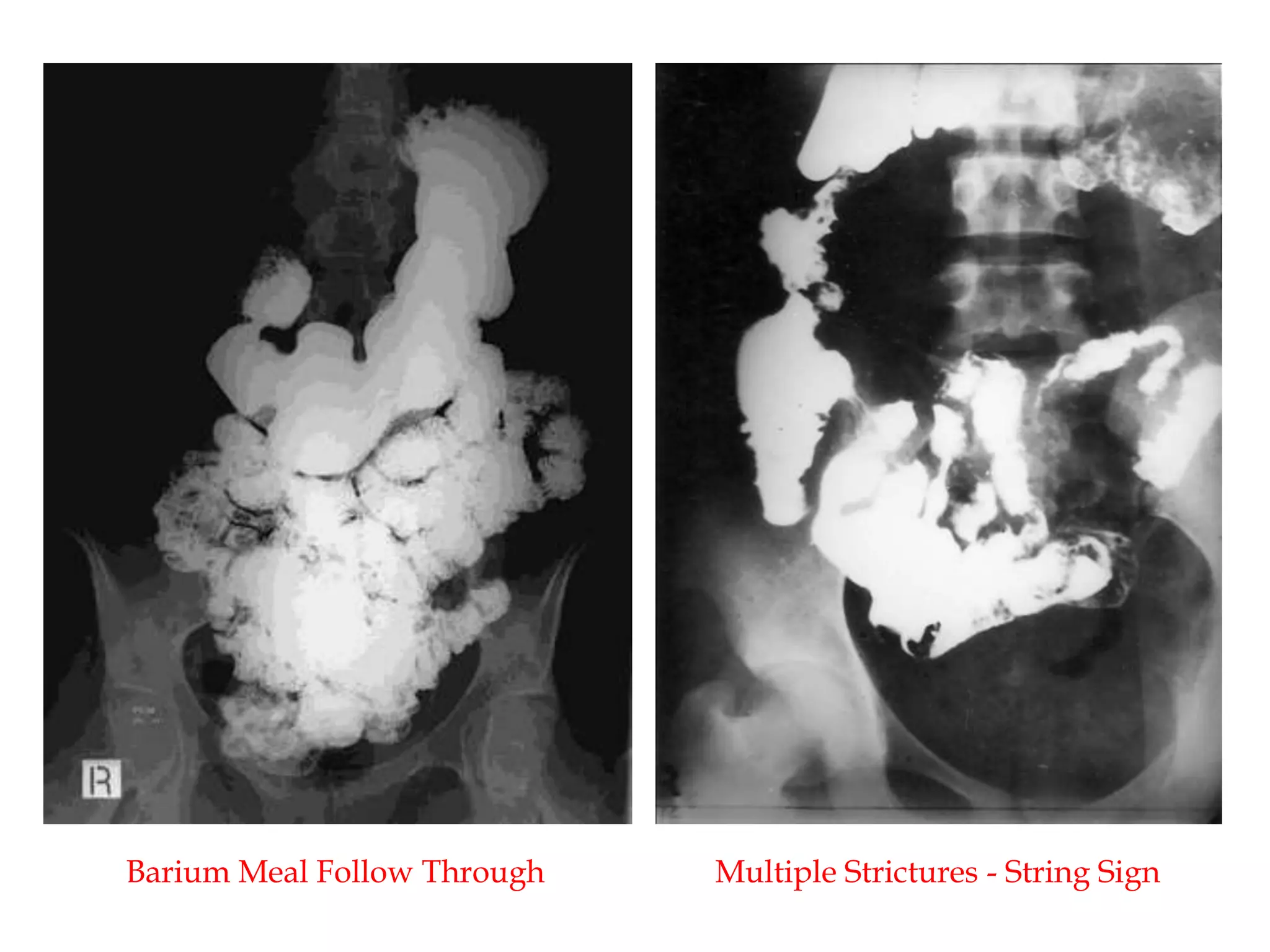 Gastro intestinal tract (abdomen) radiology | PPTX