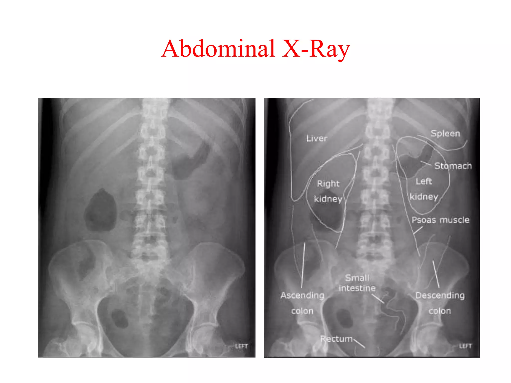 Gastro intestinal tract (abdomen) radiology | PPTX