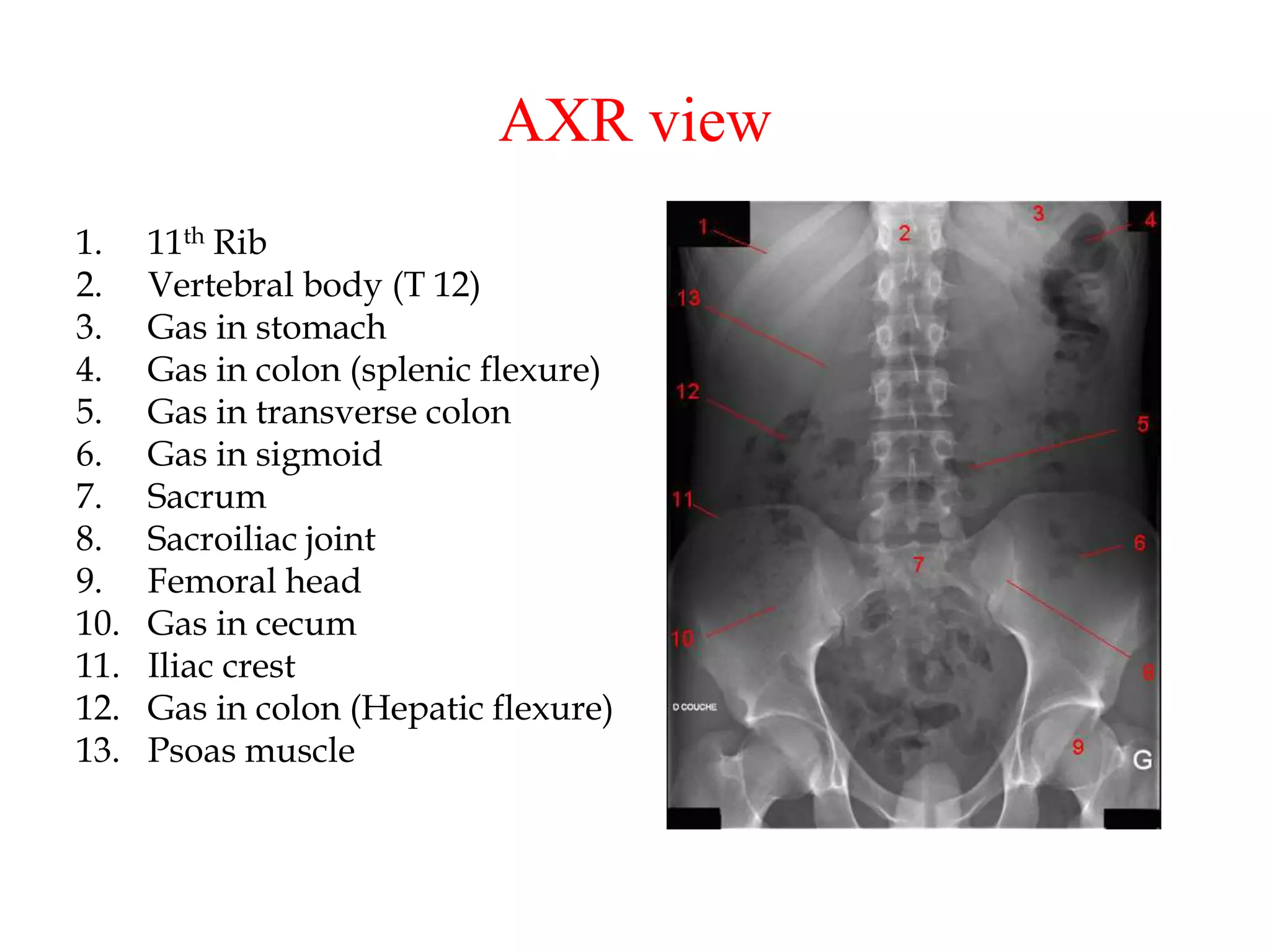 Gastro intestinal tract (abdomen) radiology | PPTX
