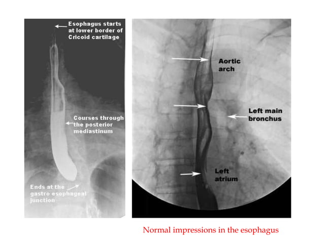 Gastro intestinal tract (abdomen) radiology | PPTX | Digestive ...