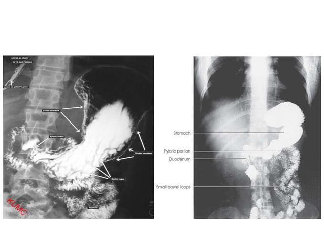 Gastro intestinal tract (abdomen) radiology | PPTX | Digestive ...