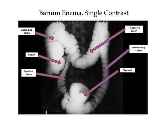 Gastro intestinal tract (abdomen) radiology | PPTX | Digestive ...