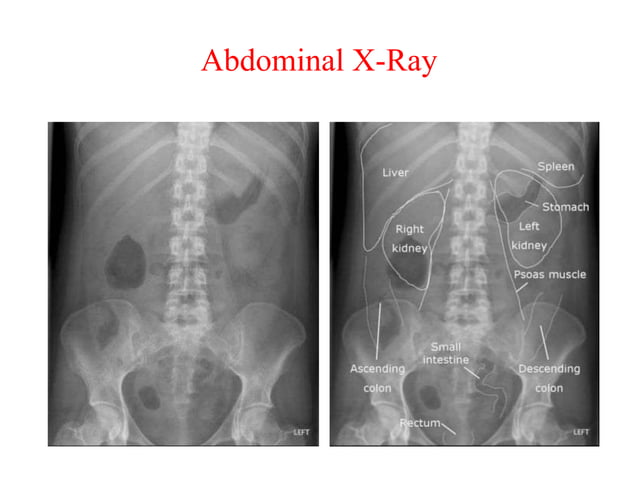 Gastro intestinal tract (abdomen) radiology | PPTX | Digestive ...