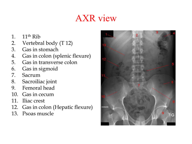 Gastro intestinal tract (abdomen) radiology | PPTX | Digestive ...