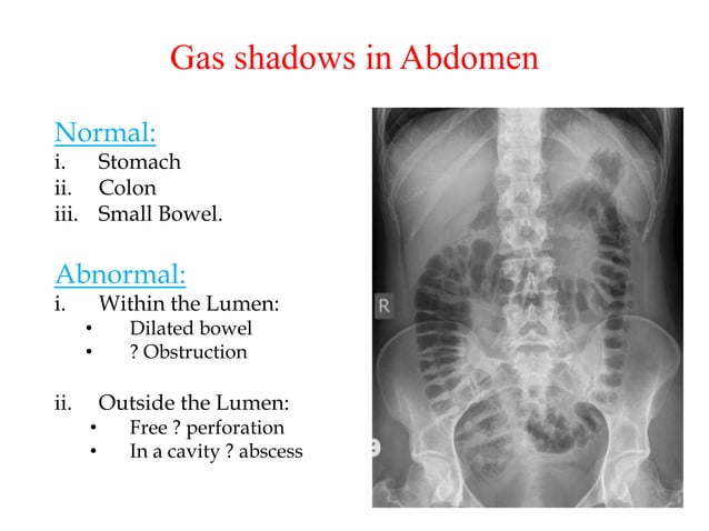 Gastro intestinal tract (abdomen) radiology | PPTX | Digestive ...
