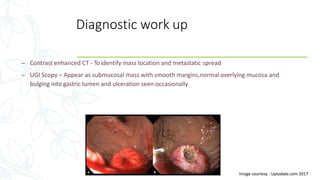 Gastrointestinal tumors | PPTX