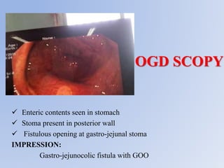 Gastrojejunocoilic fistula | PPT
