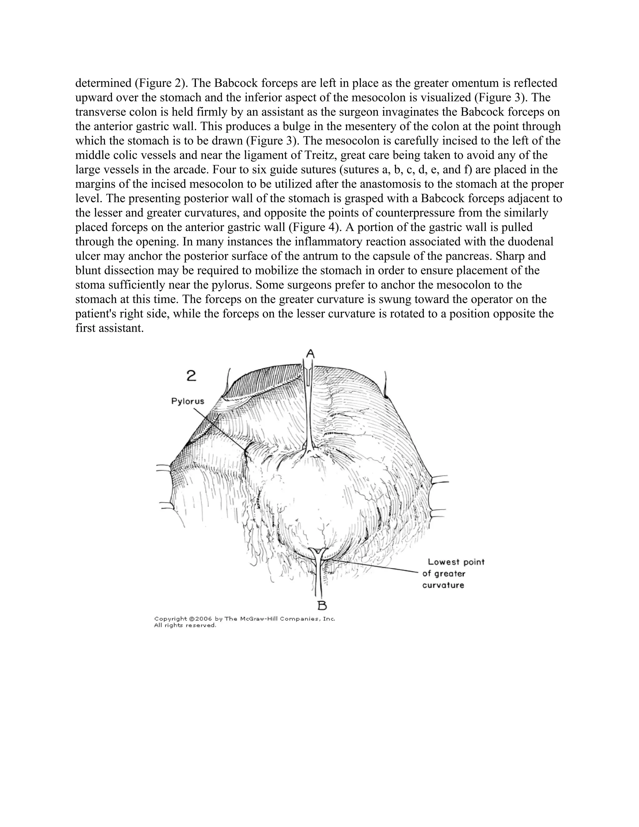 Gastrojejunostomy | DOC