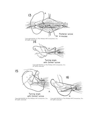 Gastrojejunostomy | DOC
