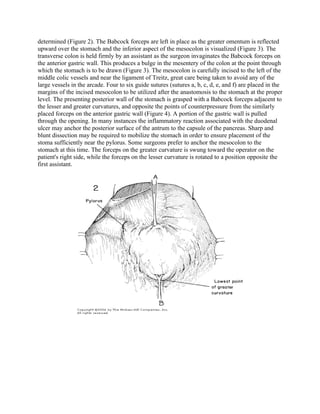 Gastrojejunostomy | DOC