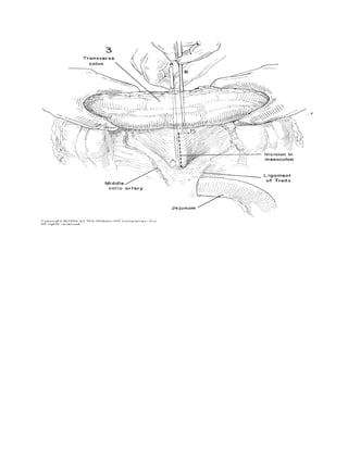 Gastrojejunostomy | DOC