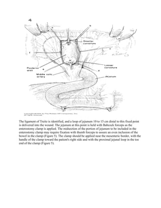 Gastrojejunostomy | DOC