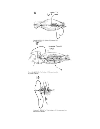 Anastomosis Gastrojejunostomy Braun Operation Truncal Vagotomy Omental ...