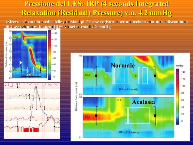 Malattie motorie dell'esofago e manometria HR - Gastrolearning®