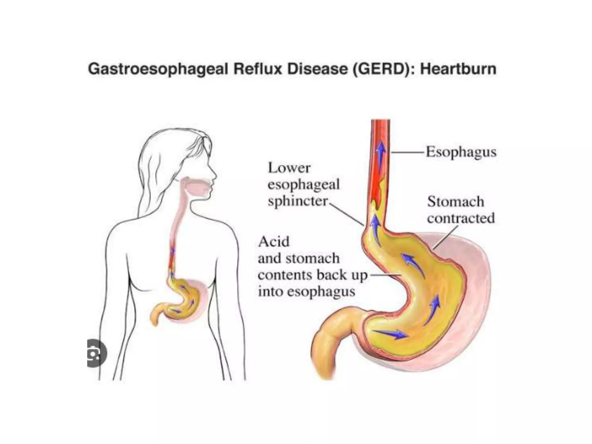 Gastro Oesophagal Reflux Disease GERD.pptx