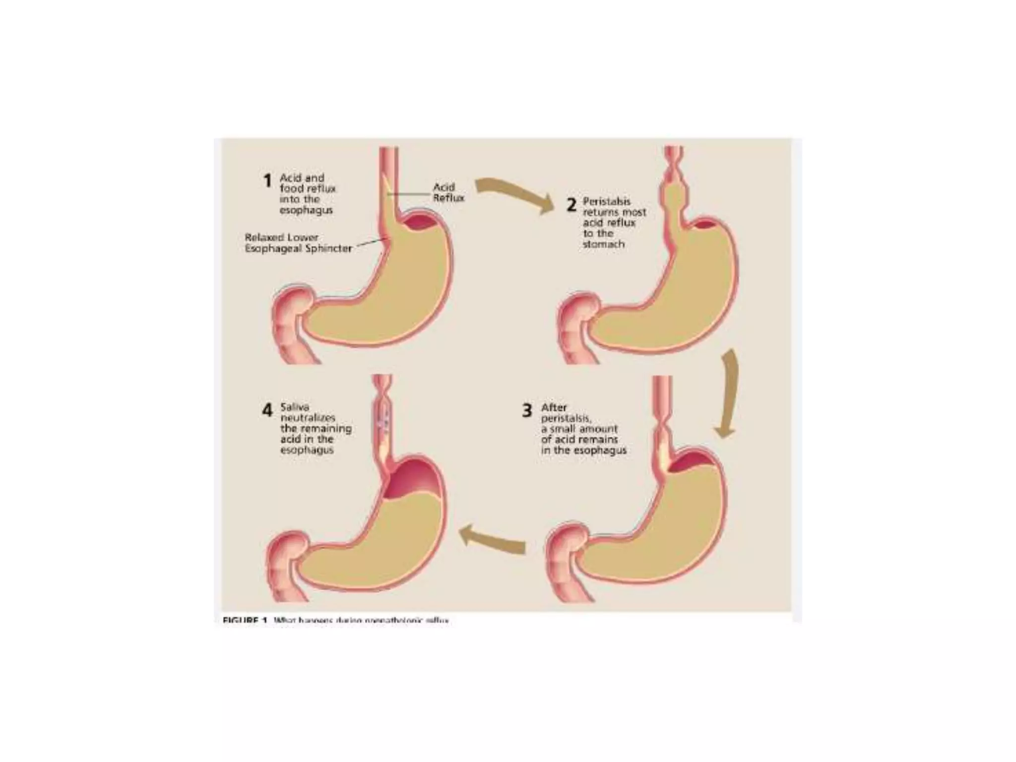 Gastro Oesophagal Reflux Disease GERD.pptx