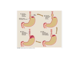 Gastro Oesophagal Reflux Disease GERD.pptx