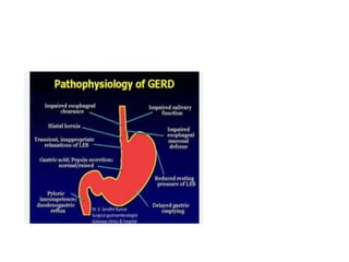 Gastro Oesophagal Reflux Disease GERD.pptx