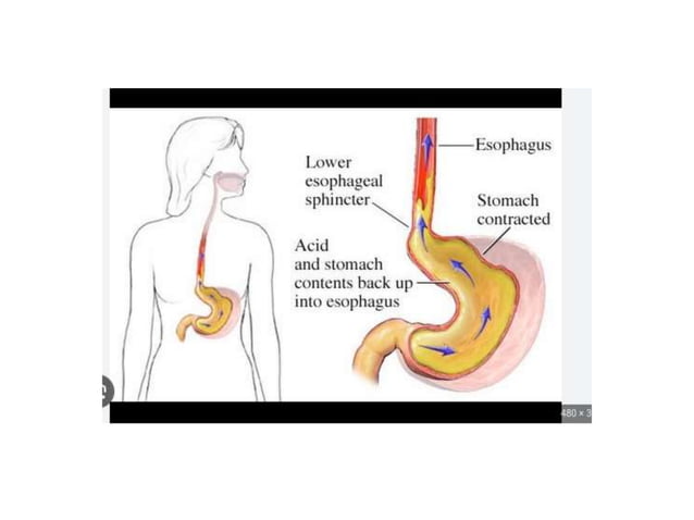 Gastro Oesophagal Reflux Disease GERD.pptx | Digestive Disorders ...