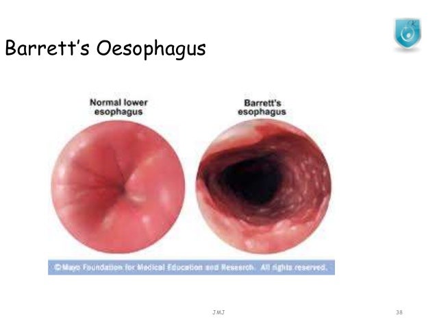 Gastro oesophageo reflux disease (GORD)