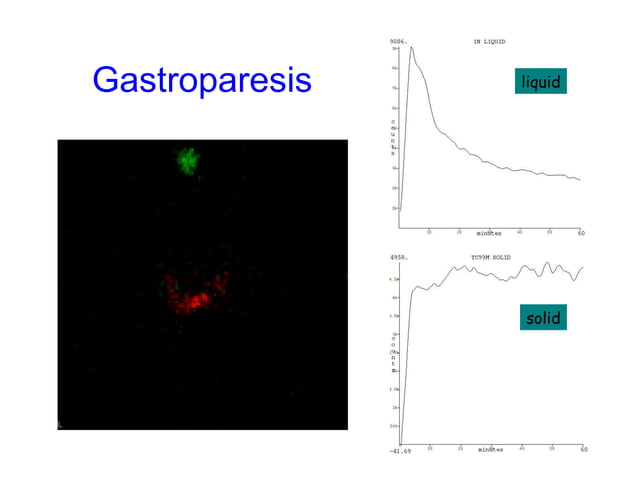 Gastroparesis | PPT | Digestive Disorders | Diseases and Conditions