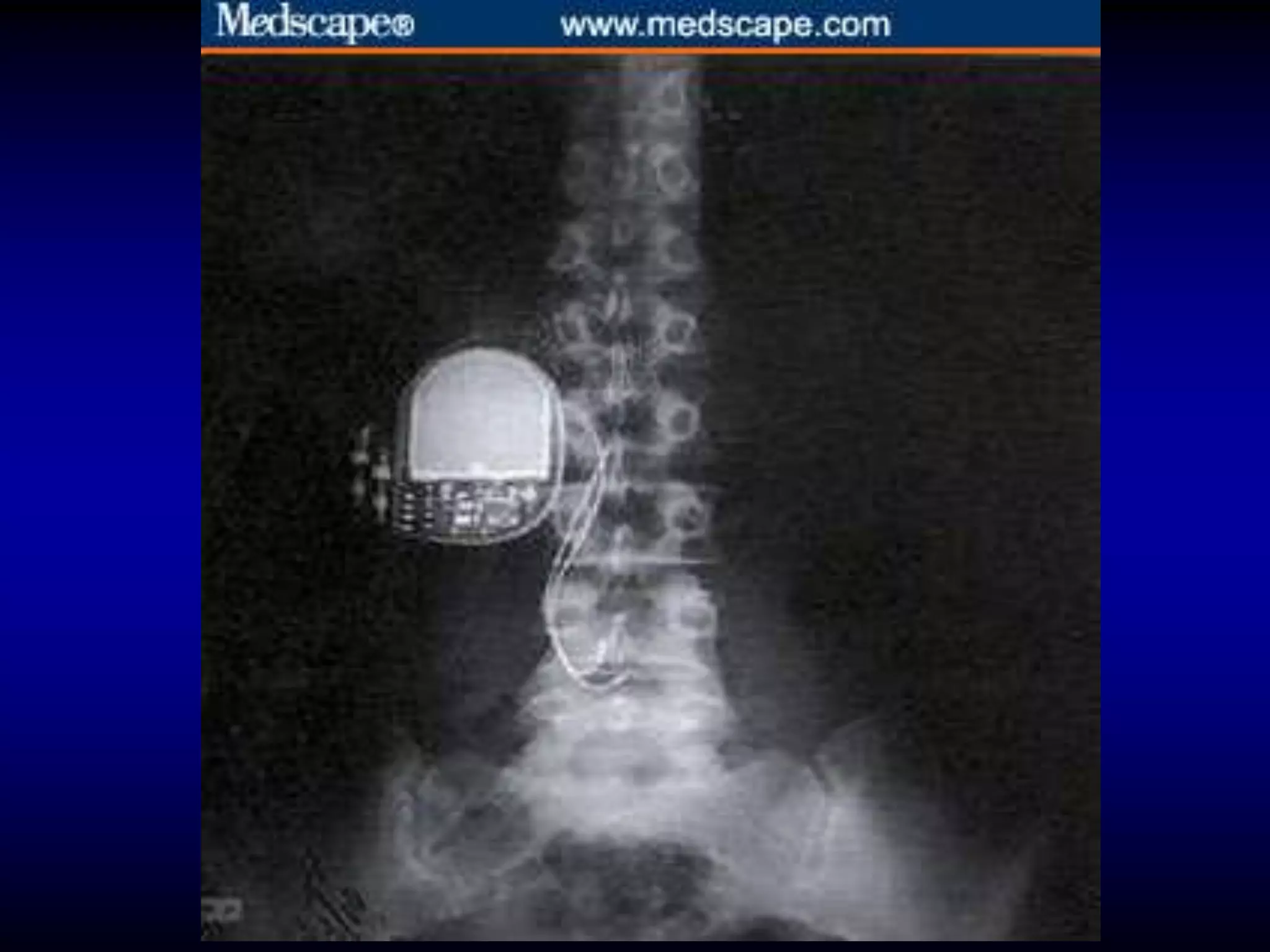 Gastroparesis slide.ppt