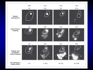 Gastroparesis slide.ppt