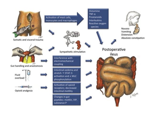 postsurgical gastroparesis presentation.pptx