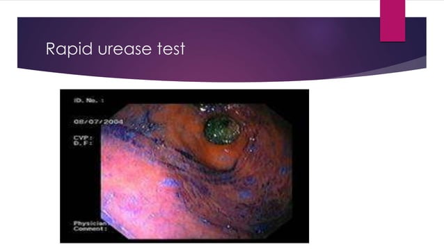 H. Pylori as an etiological factor in Peptic ulcer disease. | PPTX ...