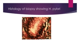 H. Pylori as an etiological factor in Peptic ulcer disease. | PPTX