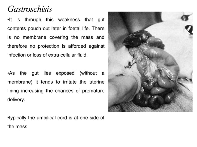 Gastroschisis | PPT | Free Download