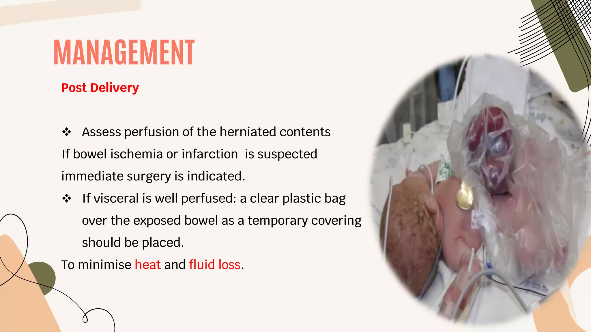 gastroschisis.pptx