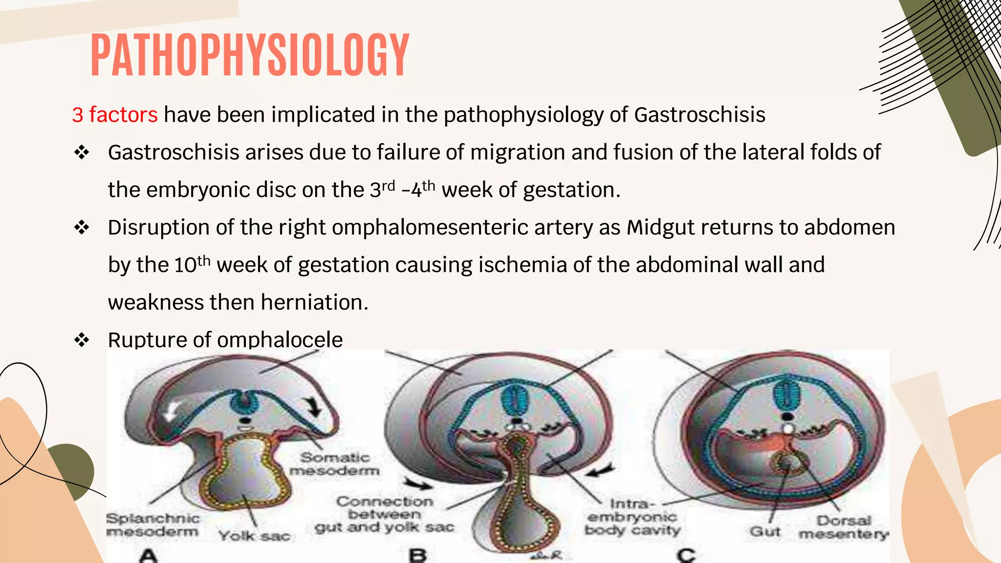 gastroschisis.pptx