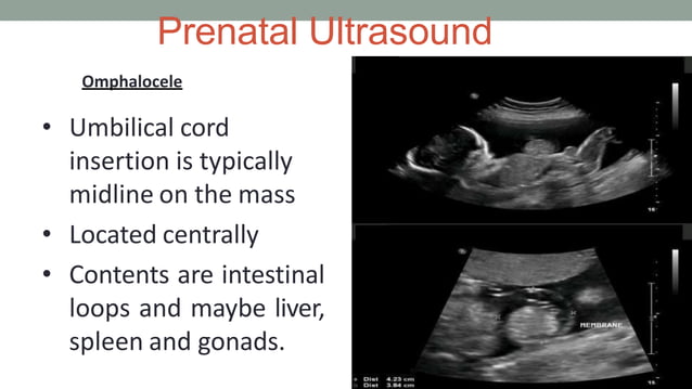 GASTROSCHISIS AND OMPHALOCELE.pptx | Pregnancy | Reproductive Health