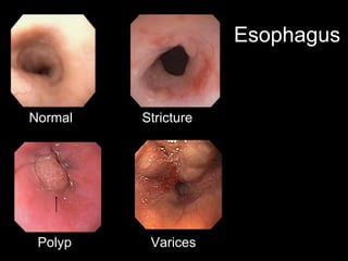 Gastroscope | PPT