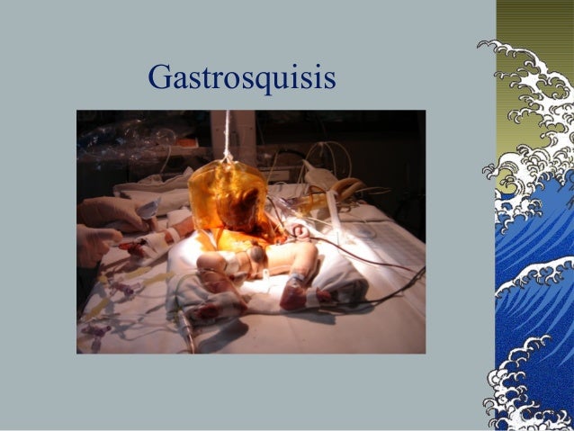 Gastrosquisis